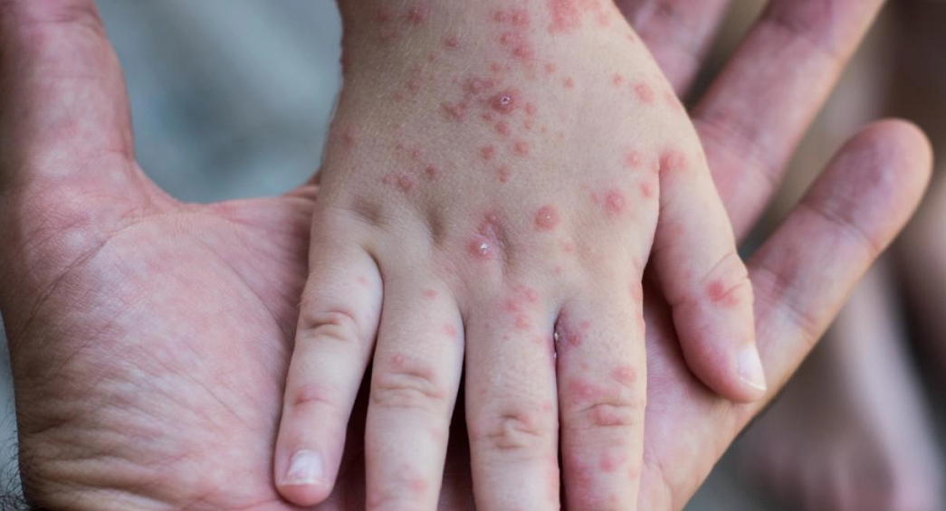WHO Issues Highest Global Alert Over Resurgent Monkeypox Outbreak ...