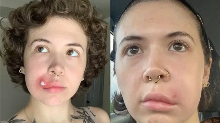 Woman nearly dies after popping pimple in the 'Triangle of Death ...
